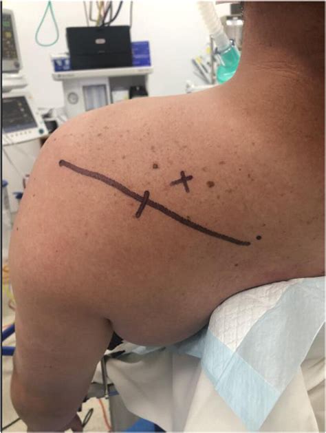 Landmark Technique For Suprascapular Nerve Block The Scapular Spine Is