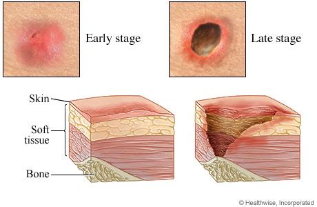 Preventing Pressure Ulcers My Doctor Online
