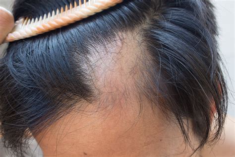 Síntomas causas y tratamientos de la alopecia difusa