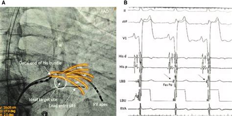 Left Posterior Fascicular Pacing A A Right Anterior Oblique 30