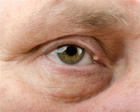 Lumps Bumps Oculofacial Plastic And Orbital Surgery