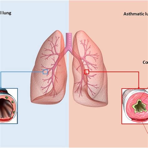 Comparison Between The Normal And Asthmatic Lung Healthy Individuals