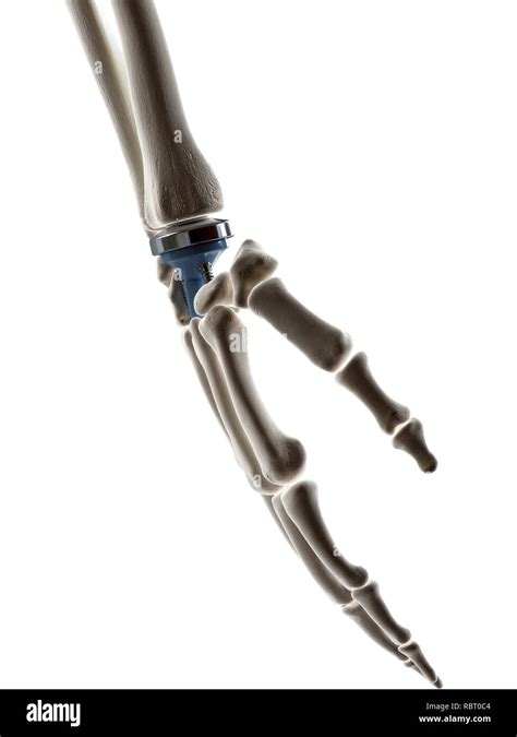 Illustration Of A Wrist Replacement Stock Photo Alamy