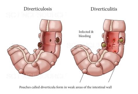 Diverticulosis And Diverticulitis Ill Stock Image Science Source
