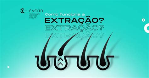 Como funciona a Extração dos Folículos Everin