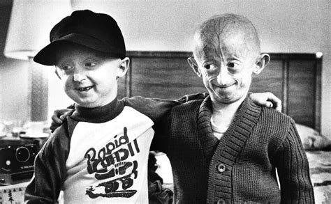 Progeria cos è la malattia di Sammy Basso che causa l invecchiamento