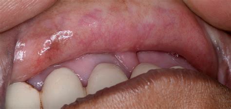Oral Submucous Fibrosis Blanching