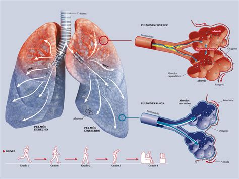 Explicar Con Im Genes La Enfermedad Pulmonar Obstructiva Cr Nica Epoc