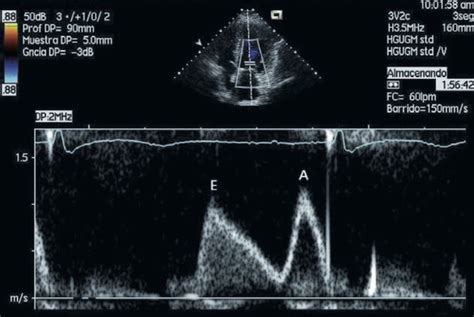 Doppler Pulsado Y Doppler Continuo