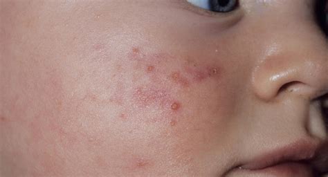 Acne Neonatorum Vs Erythema Toxicum