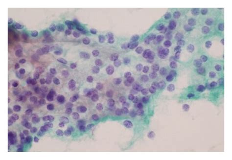 Fna Initially Reported Sheets Of Follicular Cells With Oncocytic