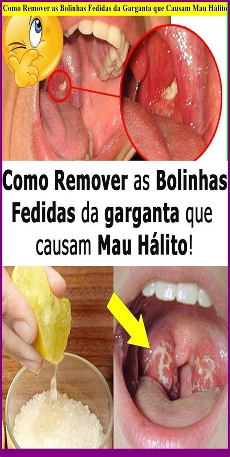 Como Remover as Bolinhas Fedidas da Garganta que Causam Mau Hálito Arm