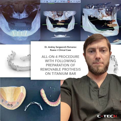 Procédure All on 4 de prothèse amovible sur barre en titane C Tech