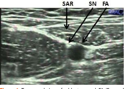 Figure 1 From Ultrasound Guided Simultaneous Adductor Canal And Sciatic