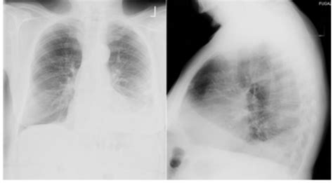 Clin Med Pleural Diseases Flashcards Quizlet