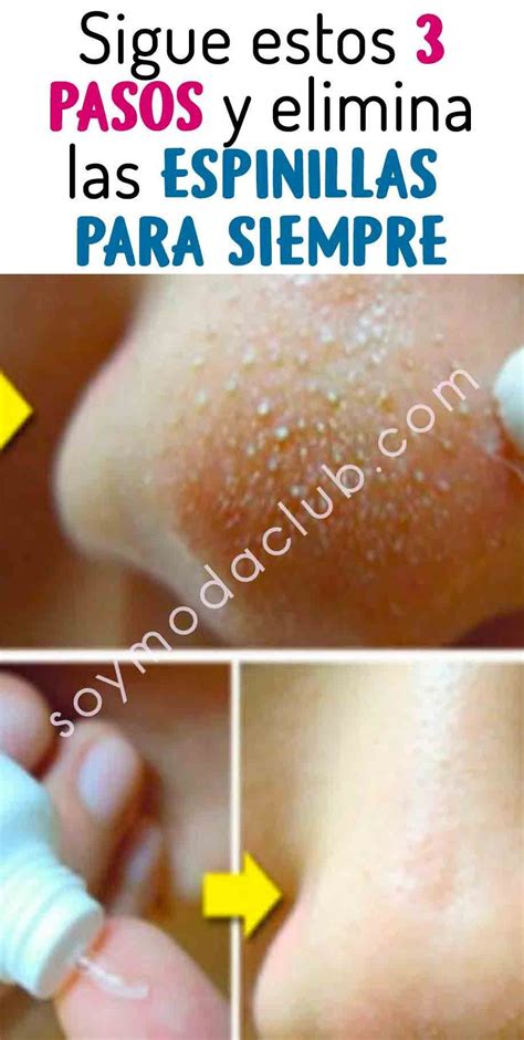 Elimina Las Espinillas Para Siempre En 3 Pasos Espinillas Belleza