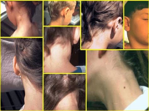 Occipital Lymph Node Behind Ear