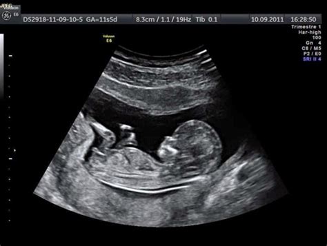 Siêu âm con gái sinh con trai tại sao lại như thế MarryBaby
