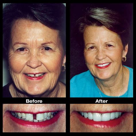 Fix Gap Spaces Teeth Bands Oppenheim Signature Smiles