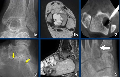 The Radiology Assistant Bone Tumors Differential Diagnosis