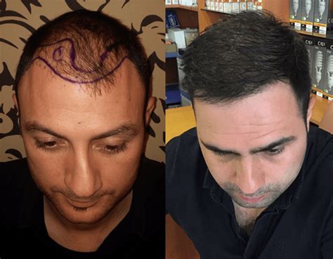 Injerto Capilar Antes Y Despu S Espa A Turqu A Cl Nica Capilclinic