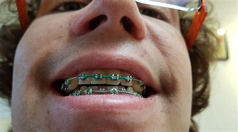 Mon Appareil Dentaire Avec Powerchain De Couleurs Verts Orthodontics