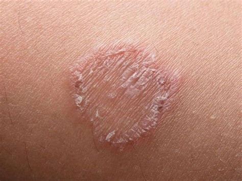 Ringworm Pictures How To Identify Ringworm On Your Body