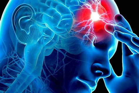 Accidente Cerebrovascular Ictus Tipos Causas S Ntomas Y Tratamiento