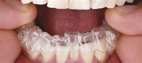 Aparato de Ortodoncia Invisible Invisalign Ribera Clínica Dental Granada