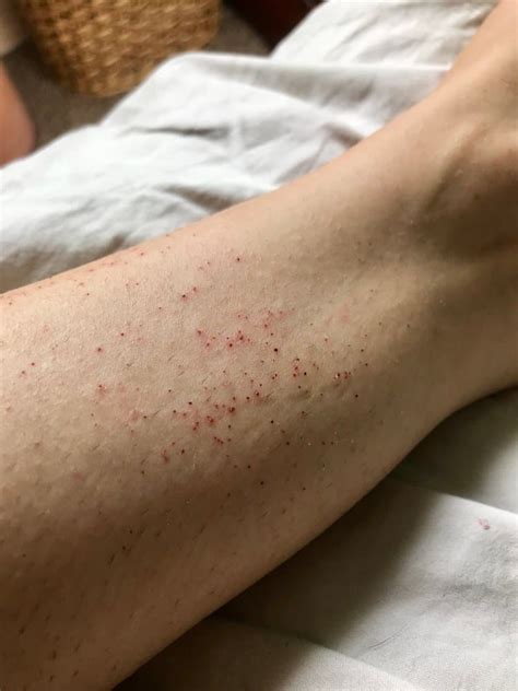 Razor Bumps On Legs Wont Go Away