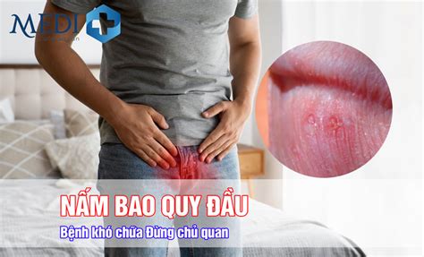 Nấm bao quy đầu Bệnh khó chữa đừng chủ quan