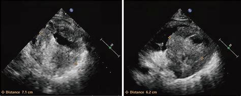 What Is The Truth Behind Abnormal ECG Changes Circulation
