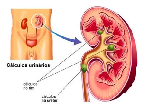 Tudo sobre Pedra nos Rins Dr Raphael Kato Médico Urologista
