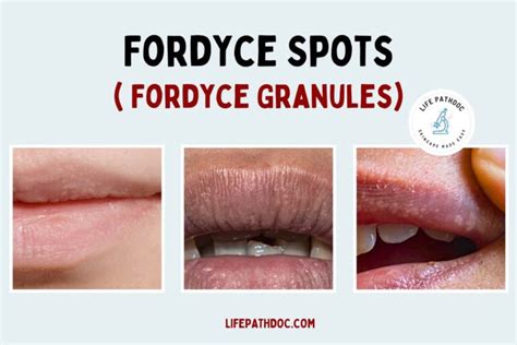 Fordyce Spots Identification Causes Treatment
