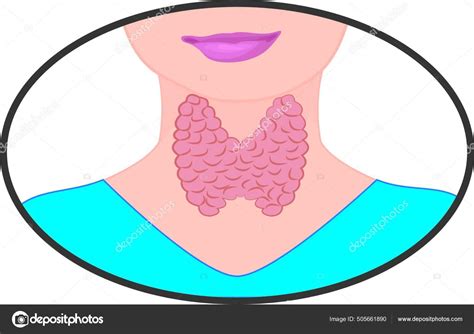Bocio Tiroides Agrandada Ilustración Vectorial Disfunción Endocrina
