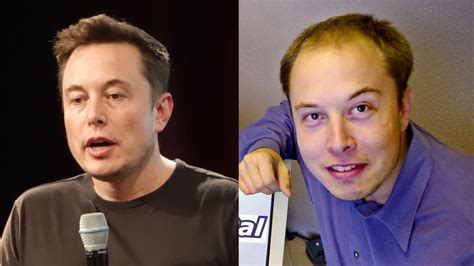 Elon Musks Incredible Hair Transplant Modena Hair Institute