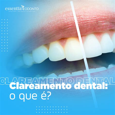 Clareamento dental o que é Blog Essentia Odonto