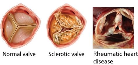 Causes Of Aortic Regurgitation Summary Critical Care Sonography