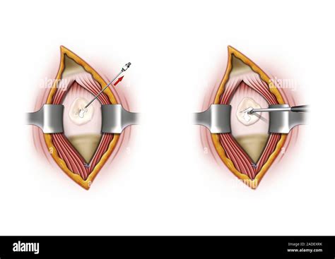 Joint Calcification Shoulder Surgery Illustration This Condition Is
