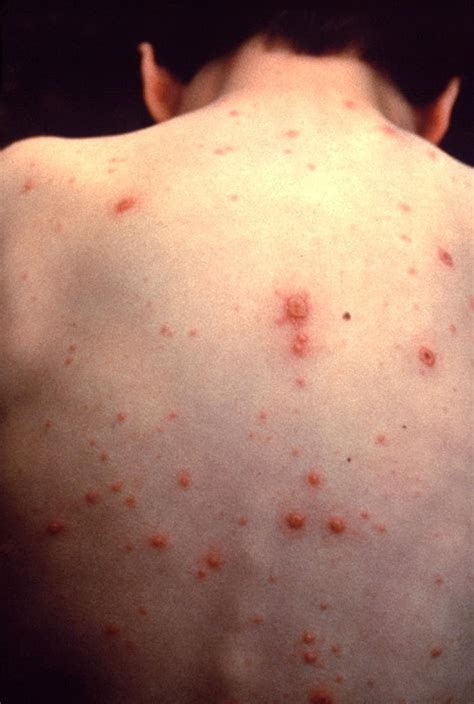 Clinical Features Of Chickenpox Varicella Chickenpox Varicella Cdc