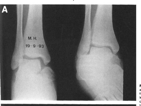 Figure 1 From Talar Neck Fracture With Talar Head Dislocation And