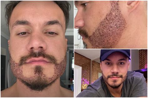 EX BBB Eliézer fez harmonização facial entenda o que mudou IGN Boards