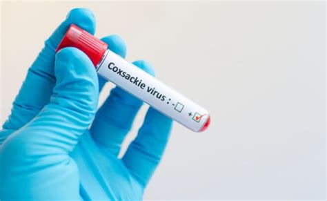 Qué es y cuáles son los síntomas del virus de Coxsackie Así puedes