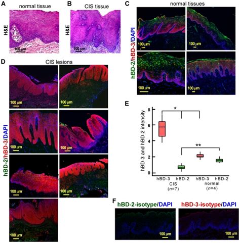 A And B H E Images In Normal Oral Epithelium A And CIS Lesion B