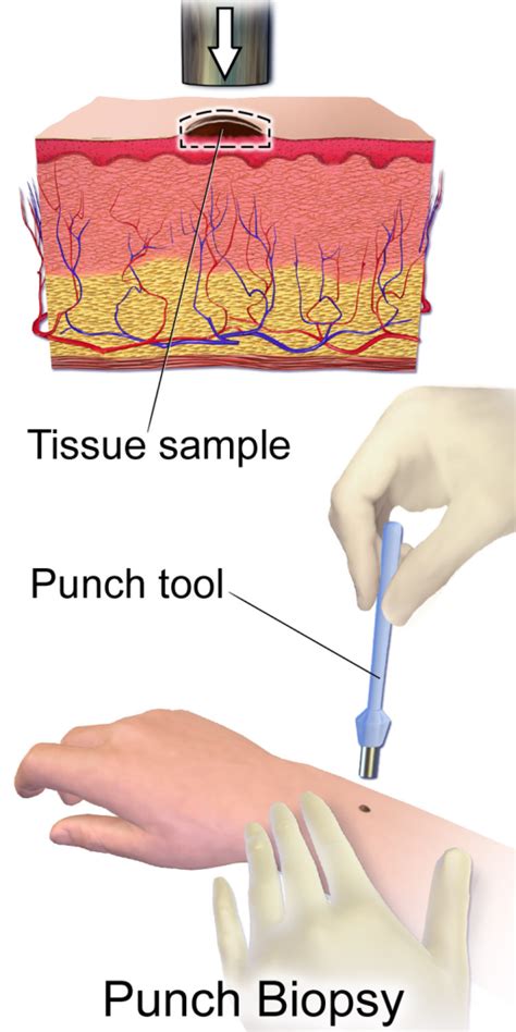 Biopsie cutanée Guide complet Groupe Santépourtous