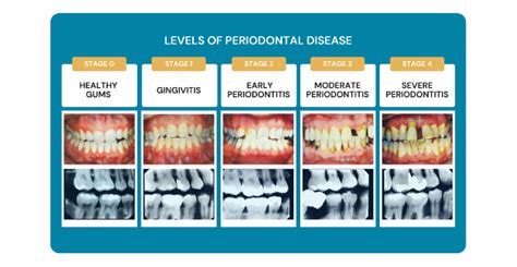 Desarrollo De La Enfermedad Periodontal En Fases The Best Porn Website