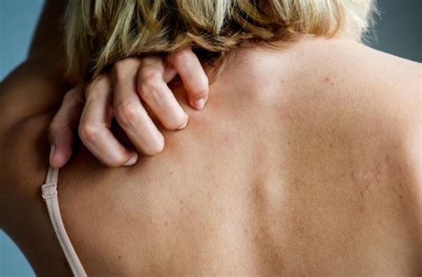 Gale définition symptômes traitements et causes