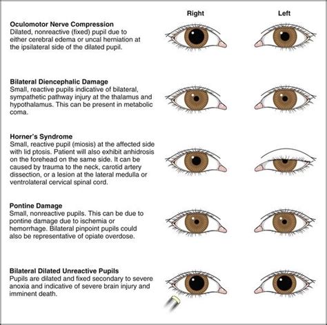 Pupil Size Chart Normal Range