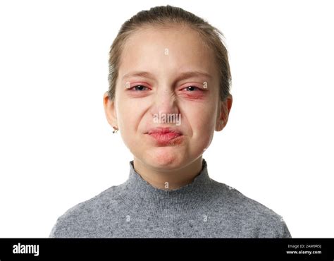 Allergic Reaction Skin Rash Close View Portrait Of A Girls Face Redness And Inflammation Of