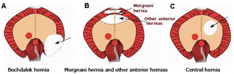 Diaphragmatic Hernia Causes Symptoms Diagnosis Treatment Prognosis